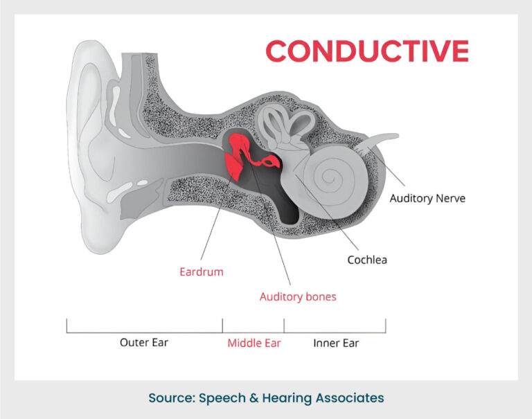 Types of Hearing Loss and Can Hearing Aids Prevent Them - Centre For ...