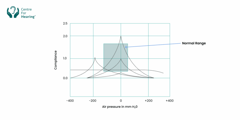 Understanding Impedance Audiometry: What it Reveals About Your Middle ...